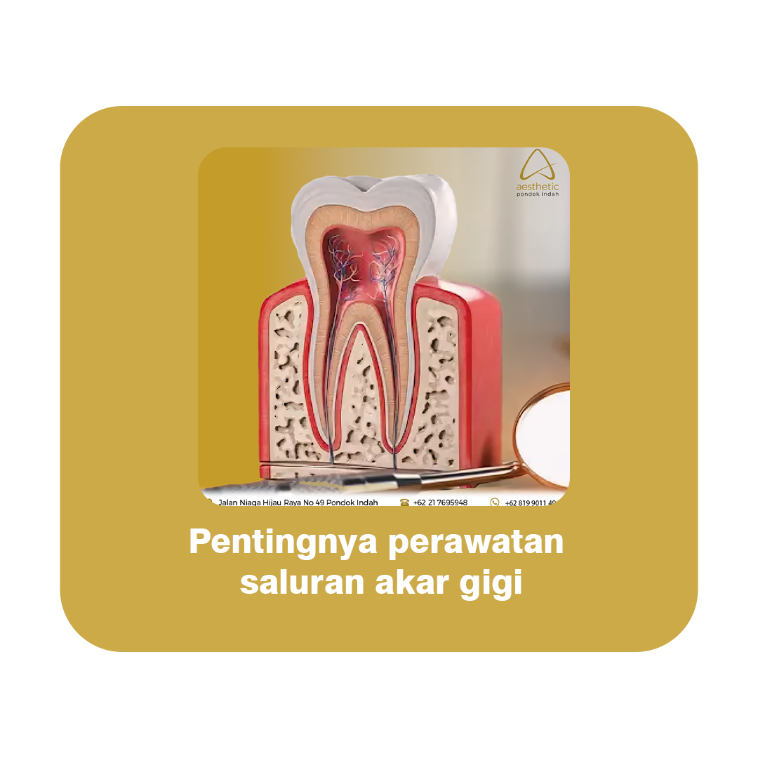 Root Canal Treatment - Klinik Gigi Jakarta - Dokter Gigi Jakarta ...
