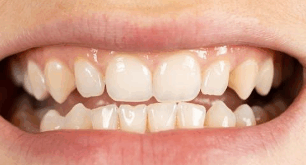 Perawatan Ortodonti untuk Gen Z: Cara Modern Merapikan Gigi Tanpa Harus ...